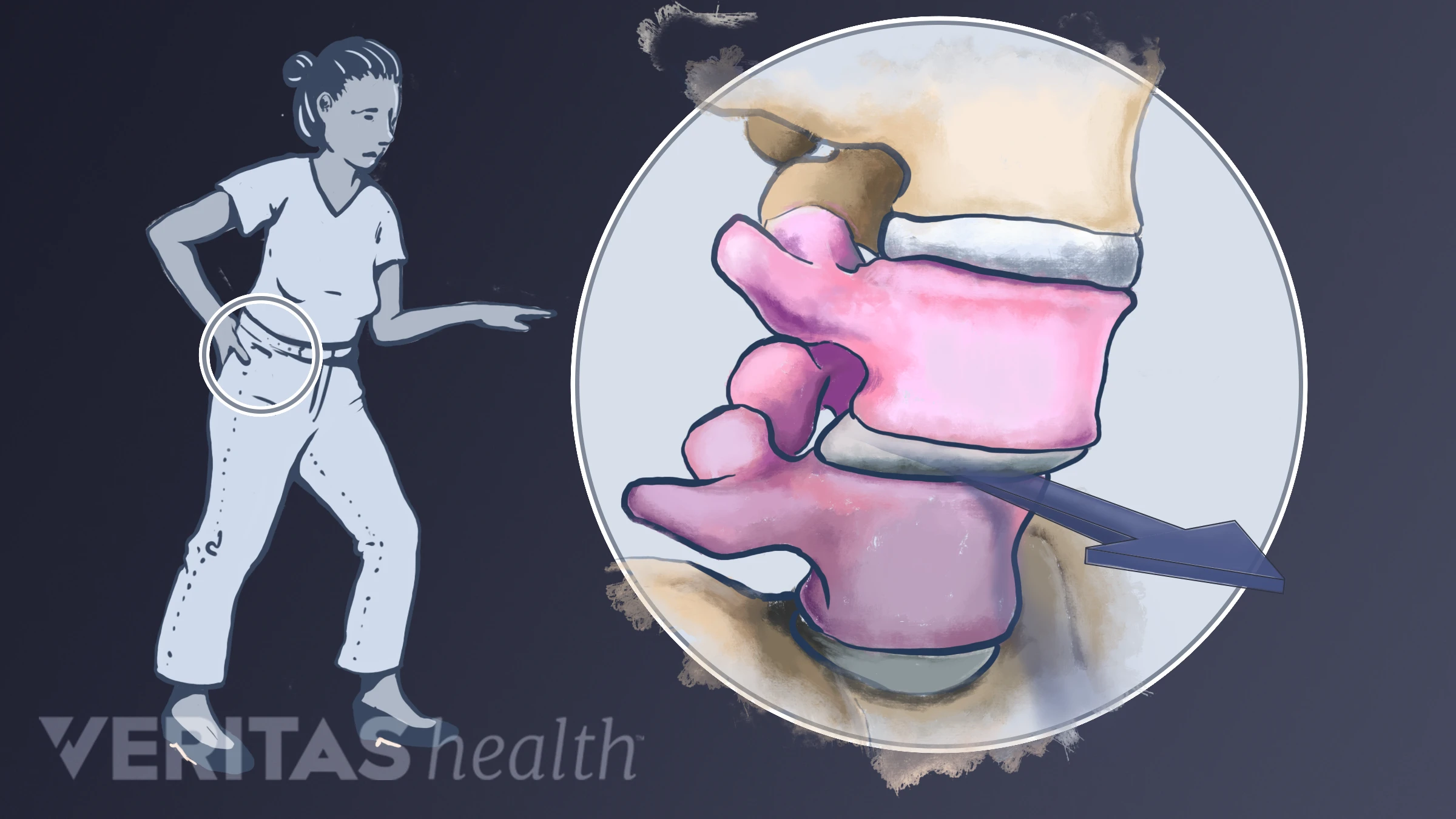 Degenerative Spondylolisthesis Symptoms | Spine-health