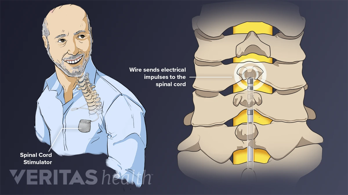 Spinal Cord Stimulators and Pain Pumps: Implantable Systems for ...