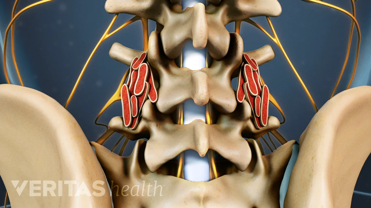 Failed Spinal Fusion Surgery | Spine-health