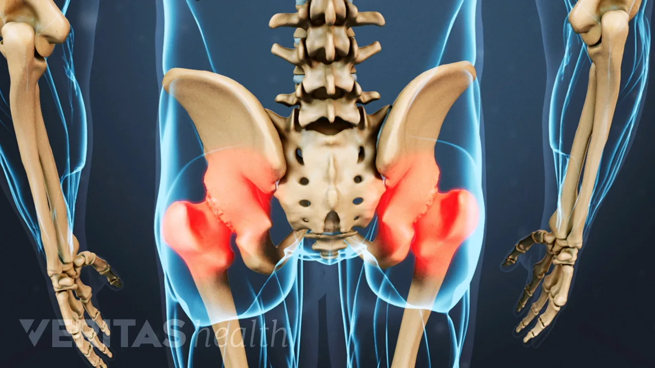 Hip Pain and Arthritis | Arthritis-health