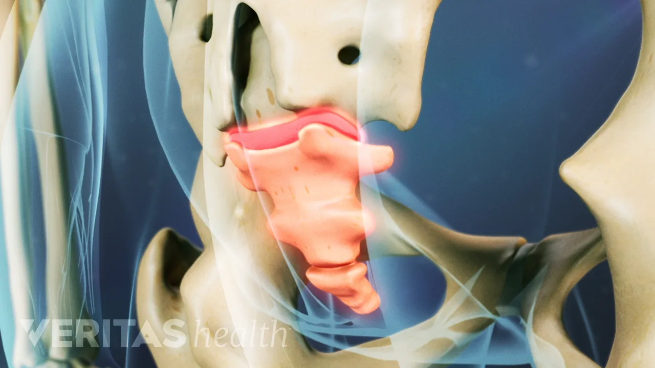 Coccydynia (Tailbone Pain) Symptoms | Spine-health