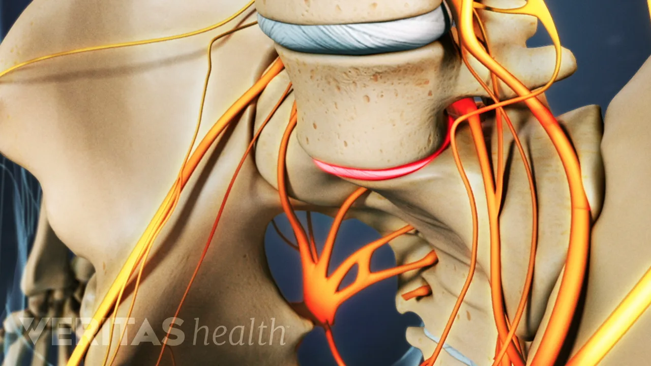 Isthmic Spondylolisthesis | Spine-health