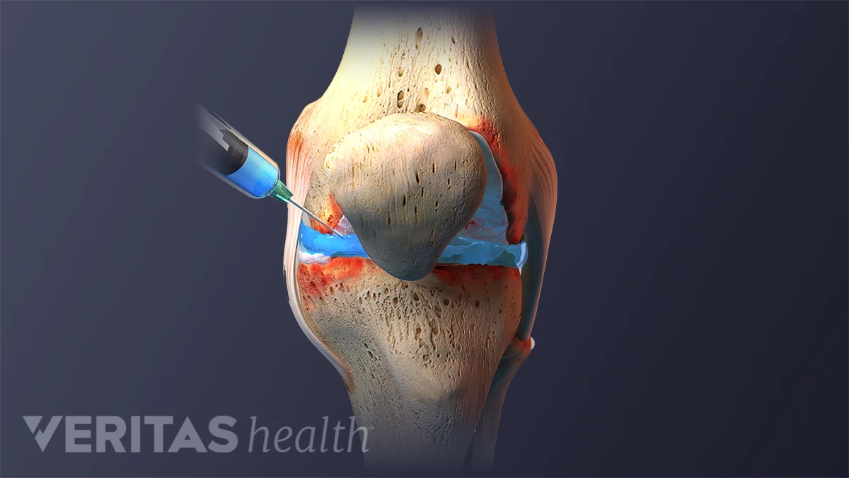 When to Consider Therapeutic Injections for Knee Arthritis Pain ...