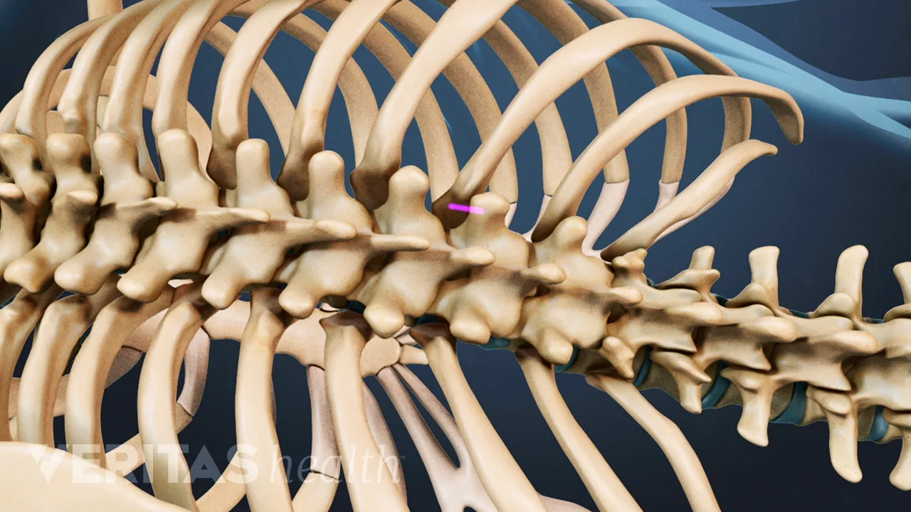 Compression Fracture Treatment | Spine-health