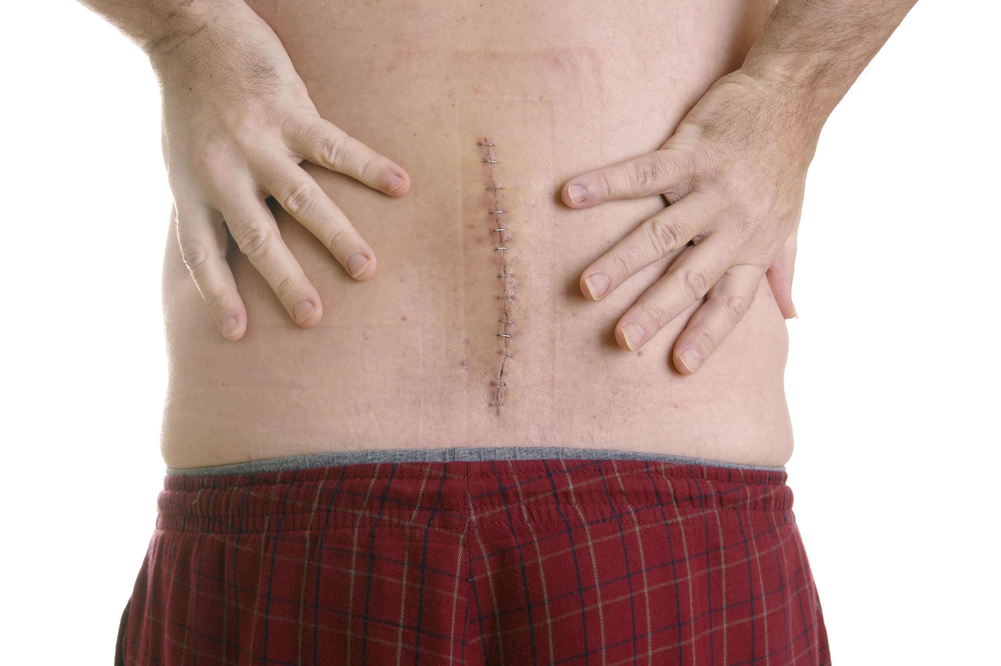 Scar Tissue and Pain After Back Surgery | Spine-health