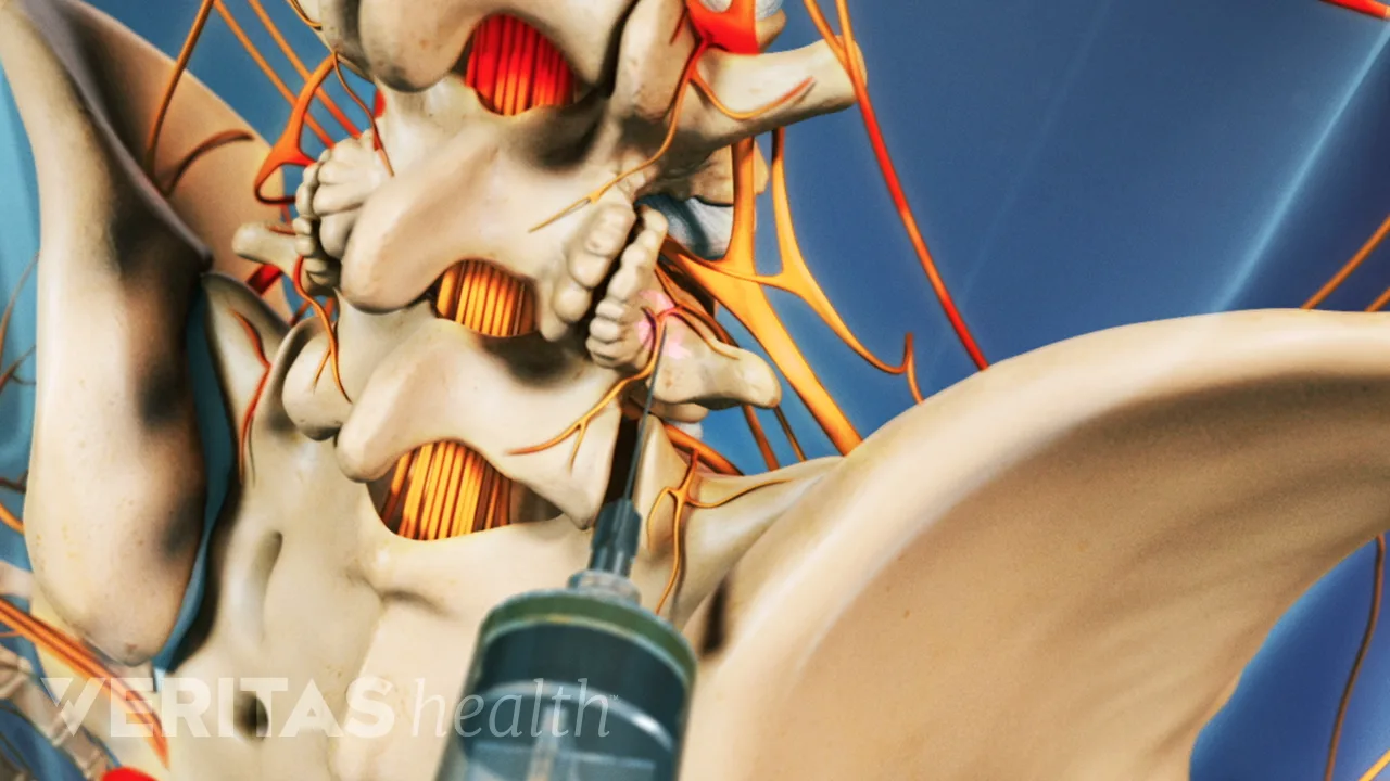 Risks and Complications of Medial Branch Blocks | Spine-health