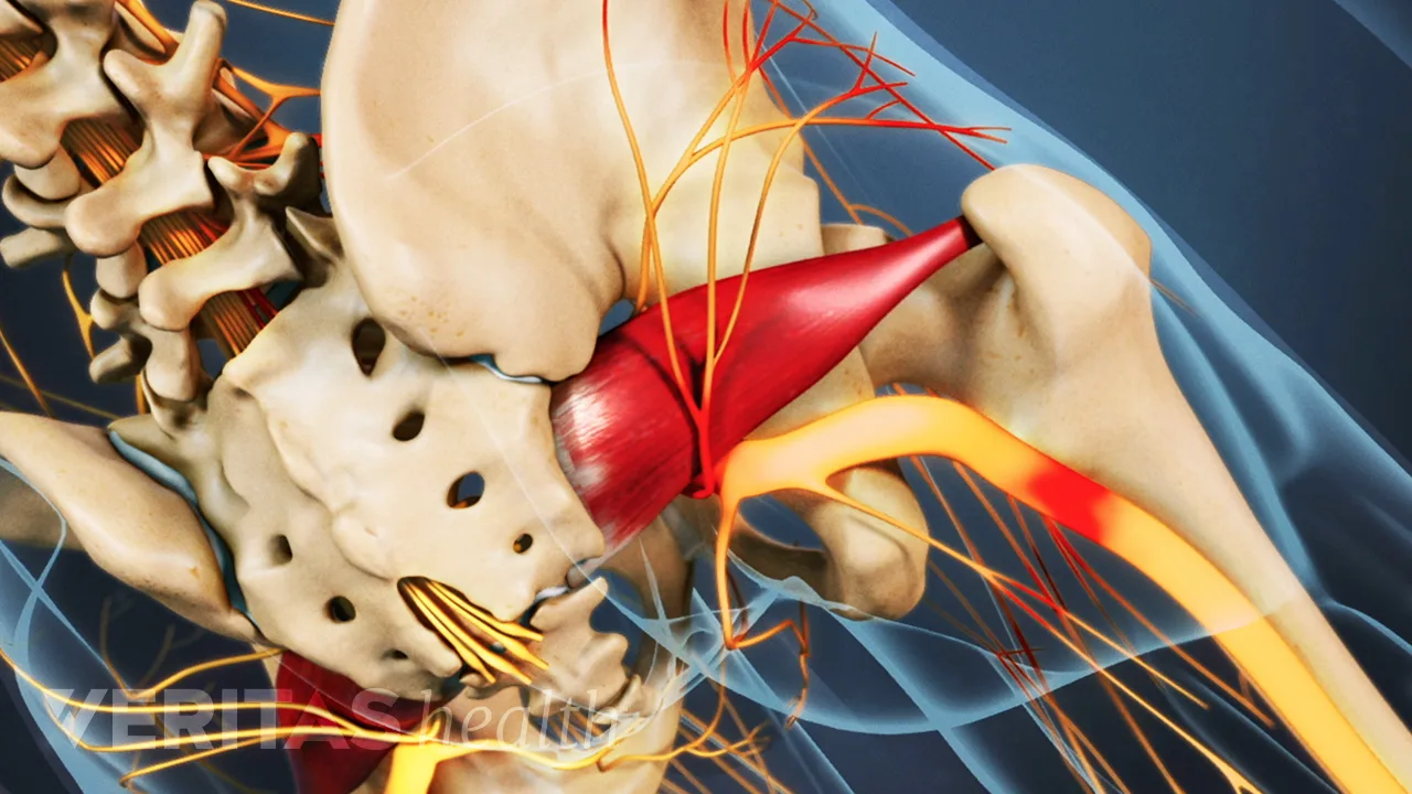 Low Back Pain with Referred Pain | Spine-health