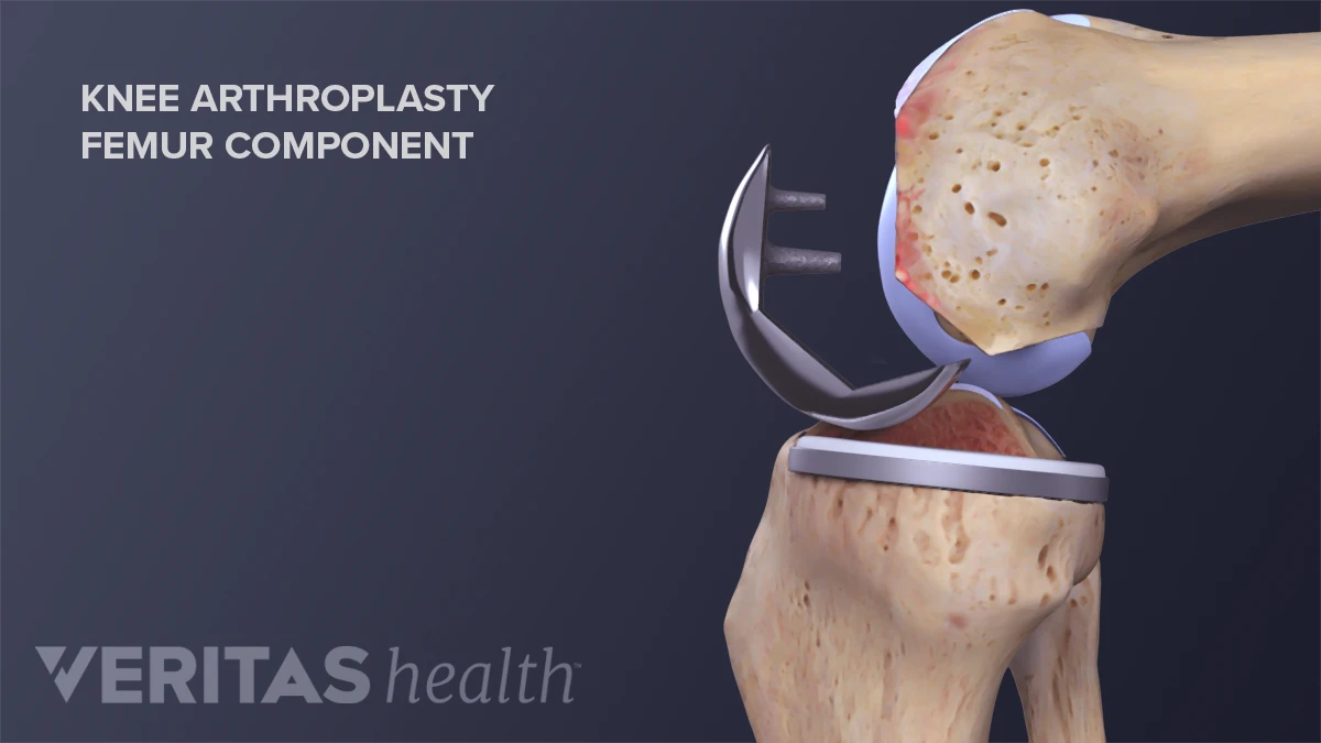 Traditional Knee Replacement vs. Minimally Invasive Knee Replacement ...
