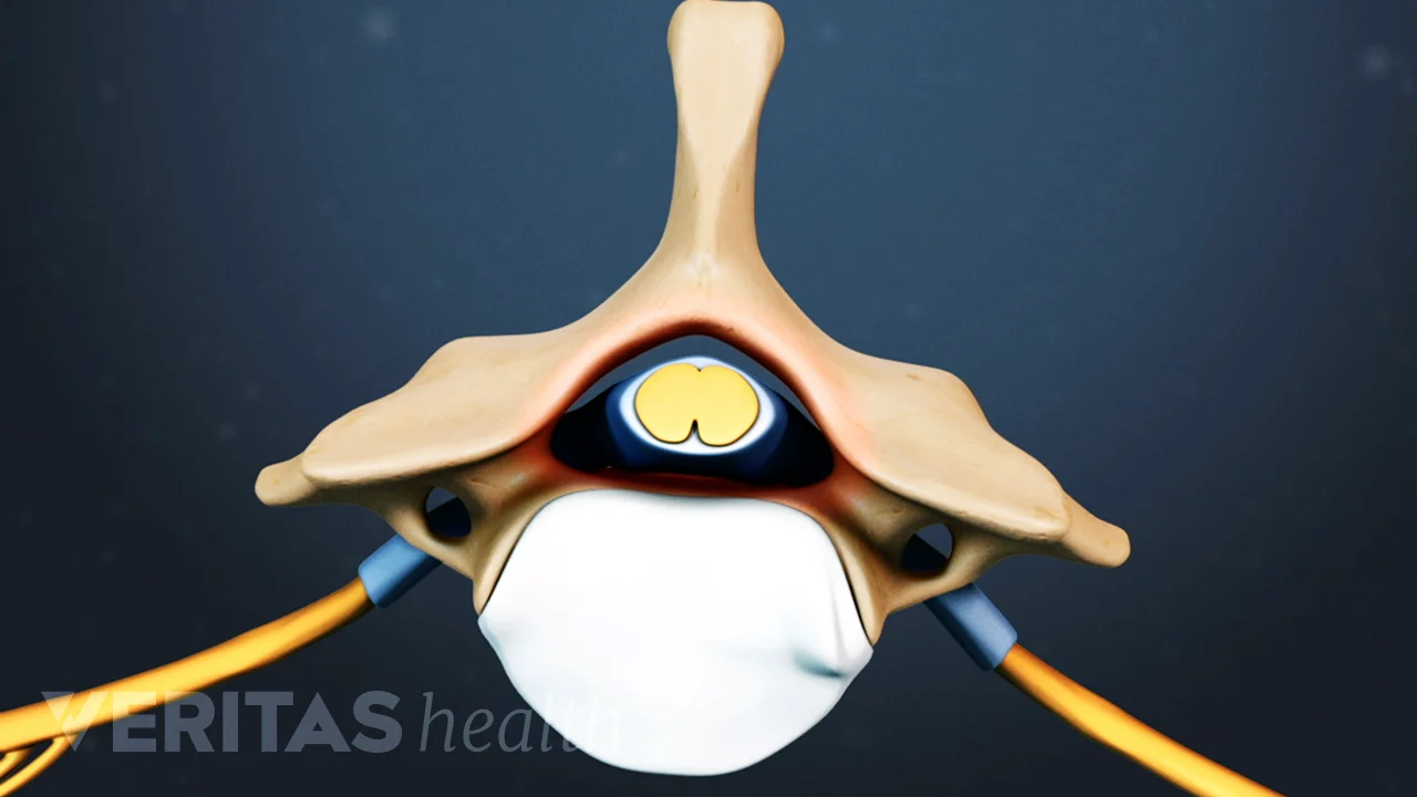 Spinal Stenosis Surgery | Spine-health