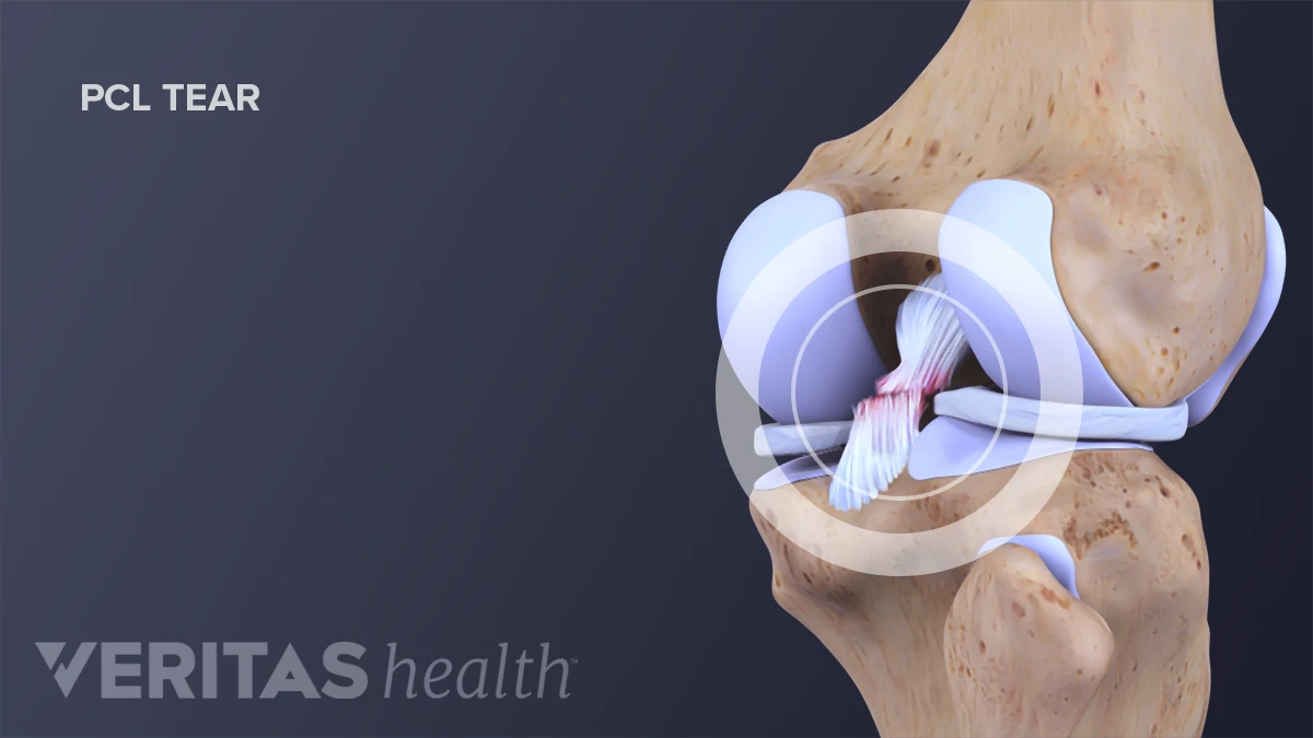 Diagnosing Posterior Cruciate Ligament (PCL) Tears | Sports-health