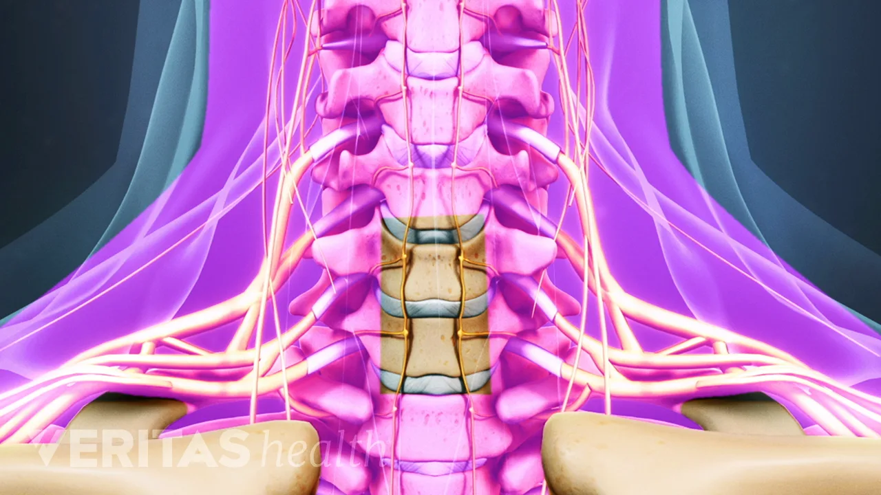 What to Expect After ACDF Surgery | Spine-health
