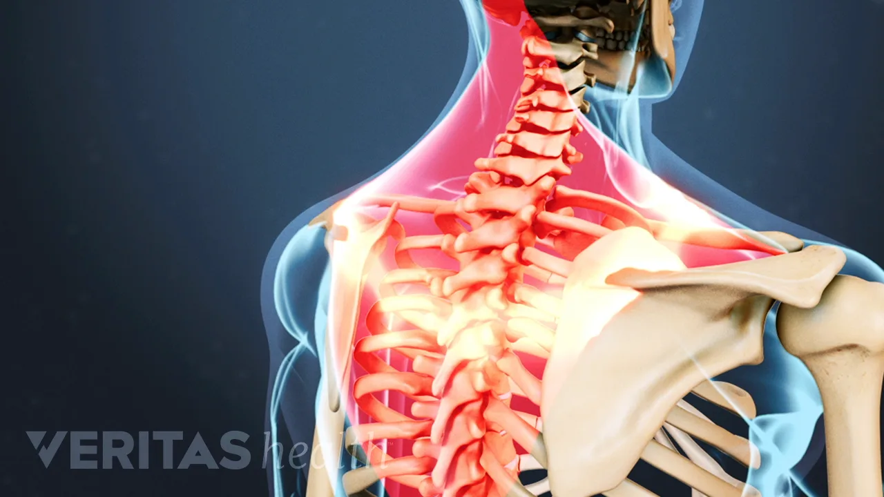 Neck Strain Symptoms | Spine-health