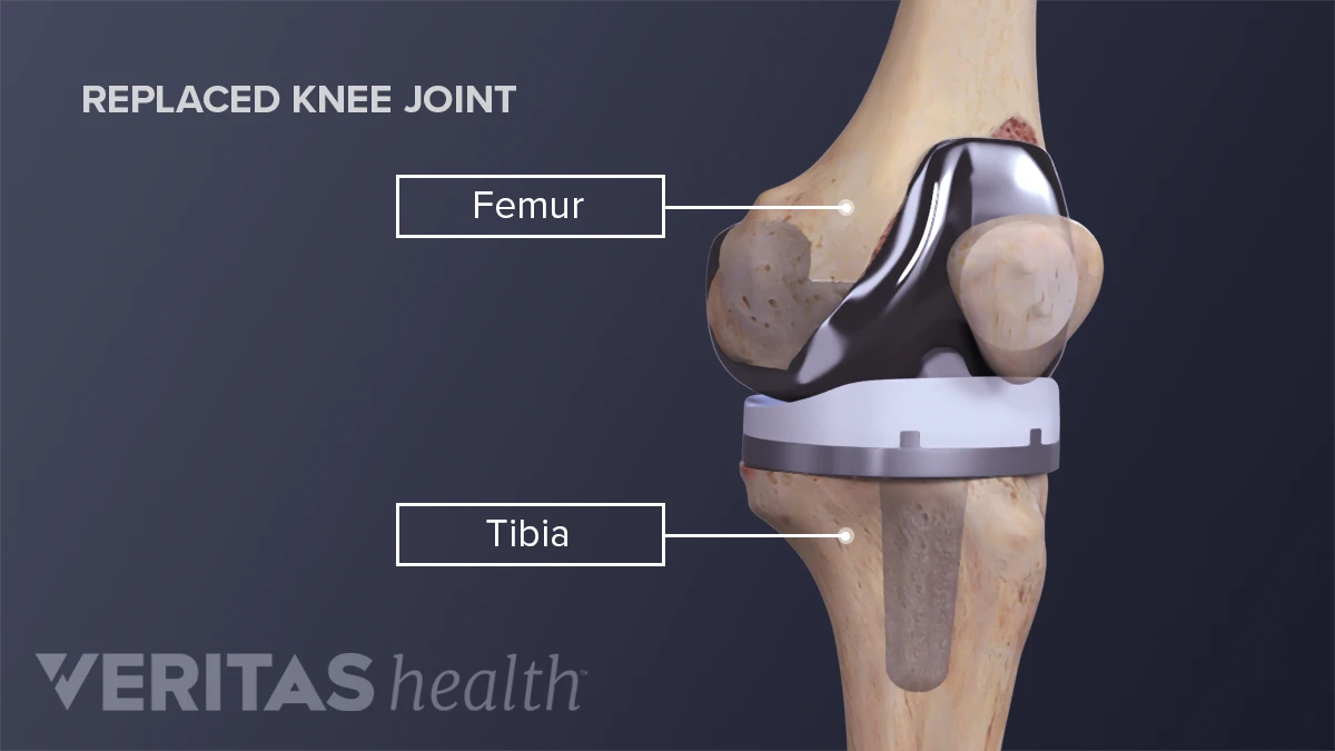 The Pros and Cons of Double Knee Replacement | Arthritis-health