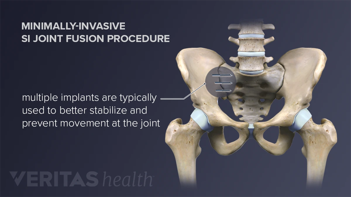 How Sacroiliac Joint Fusion is Performed | Spine-health