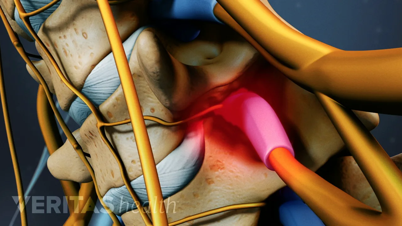Could That Shoulder Pain Really Stem From the Neck? | Spine-health
