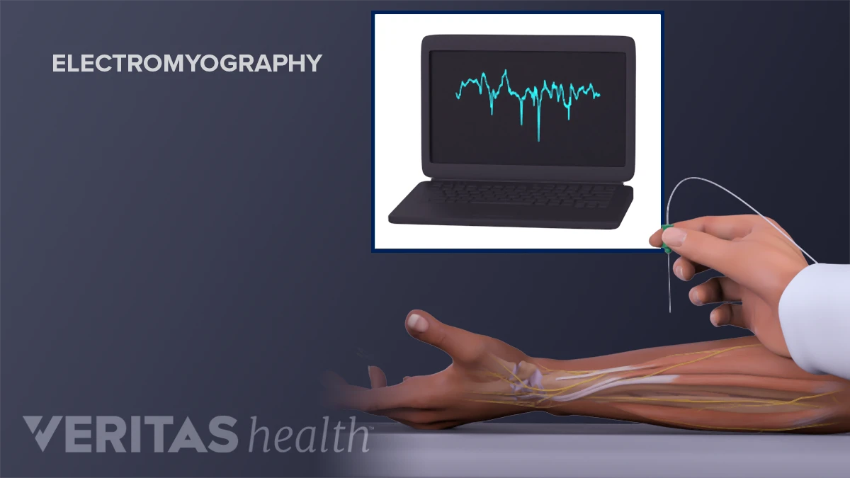 Electromyography (EMG) | Spine-health