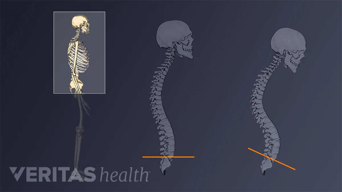Posture to Straighten Your Back | Spine-health
