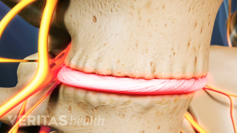 Lower Back Pain | Spine-health
