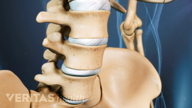 Degenerative Spondylolisthesis Video | Spine-health