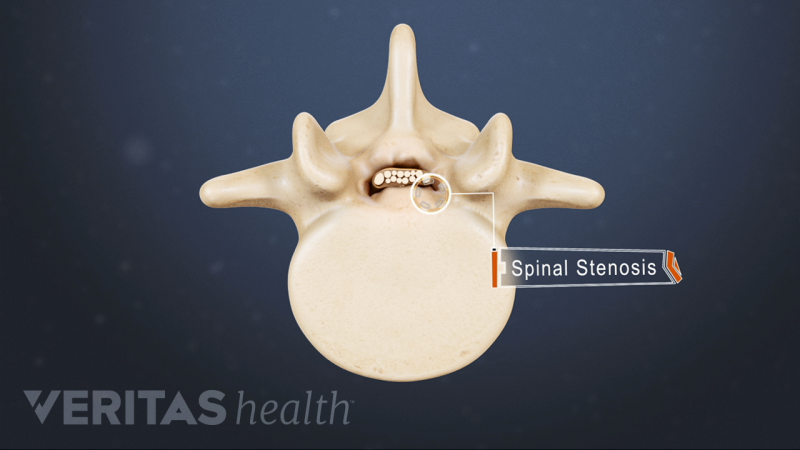 Lumbar Spinal Stenosis Video | Spine-health