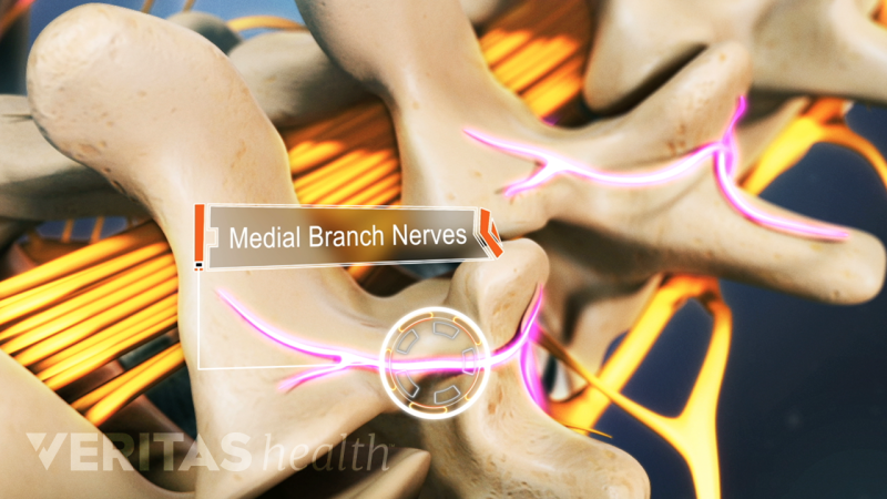 Medial Branch Block Video | Spine-health