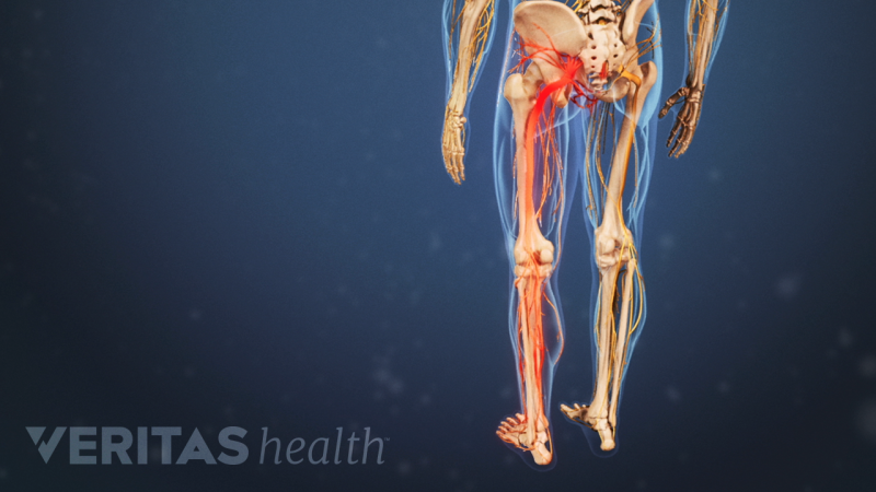 Sciatica Causes and Symptoms Video | Spine-health