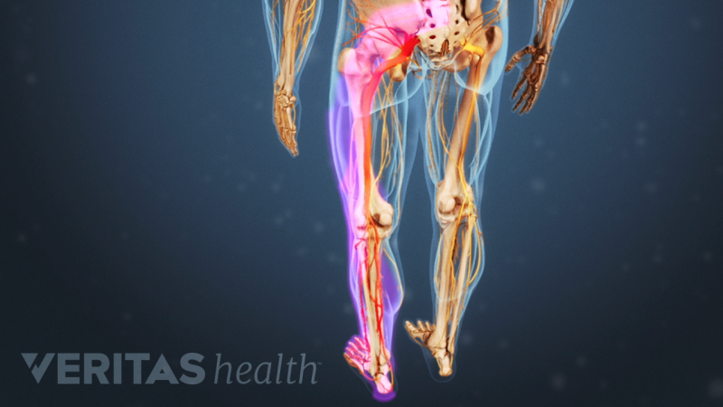 Causes of Leg Pain Video | Spine-health