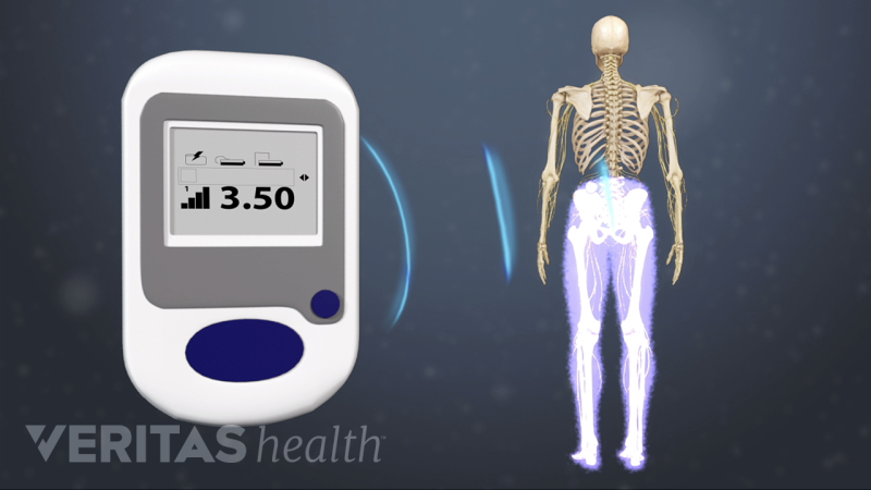 Spinal Cord Stimulation for Chronic Back Pain Video | Spine-health