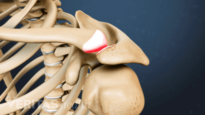 Acromioclavicular (AC) Joint Osteoarthritis Video