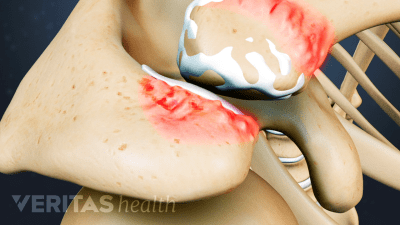 Acromioclavicular (AC) Joint Osteoarthritis Video