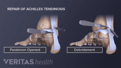 Toe-to-Wall Stretch for Achilles Tendon Pain Relief Video