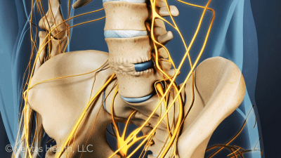Video: Stages of Bone Healing in Lumbar Spine Fusion Surgery
