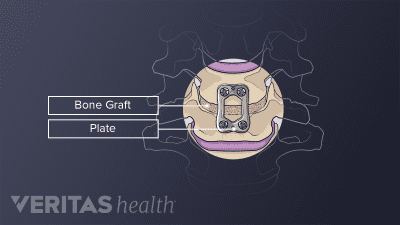 Video: Stages of Bone Healing in Lumbar Spine Fusion Surgery
