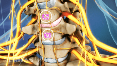 Spinal Motion Segment: C5-C6 Video