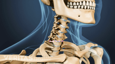 Cervical Disc Replacement Surgery Video