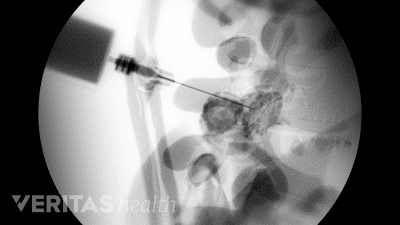 Facet Joint Injections Procedure Video
