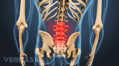 Lumbar Osteoarthritis Video