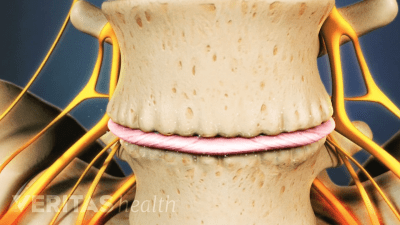 Lumbar Osteophytes (Bone Spurs) Video