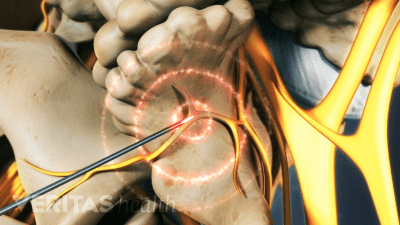 Lumbar Radiofrequency Neurotomy Video