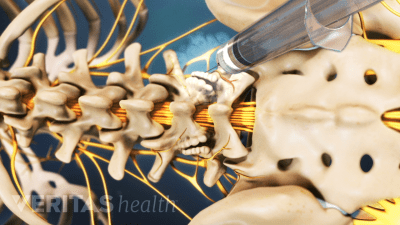 Facet Joint Injections Procedure Video