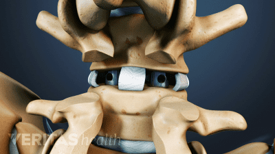 Lumbar Spinal Fusion Surgery Animation | Spine-health