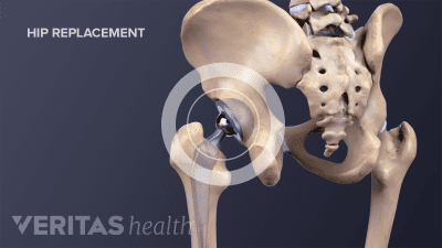 Total Hip Replacement Surgery Animation