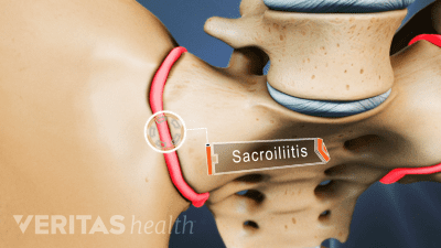 Video: What is Sacroiliitis?
