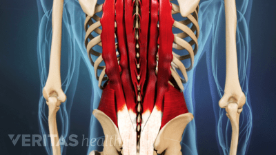 Lower Back Strain Video | Spine-health