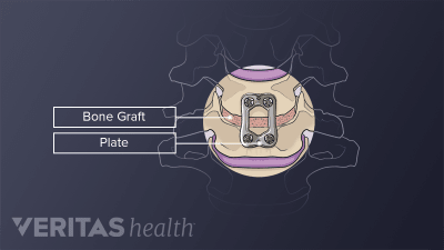 Video: Stages of Bone Healing in Lumbar Spine Fusion Surgery | Spine-health