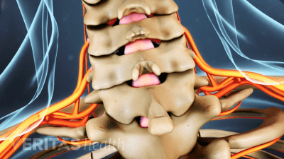 Cervical Herniated Disc Treatment Animation | Spine-health