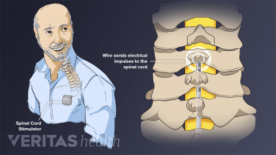 Spinal Cord Stimulation for Chronic Back Pain Video | Spine-health