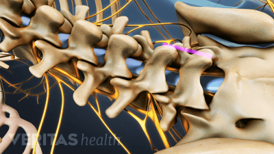 Video: Stages of Bone Healing in Lumbar Spine Fusion Surgery | Spine-health