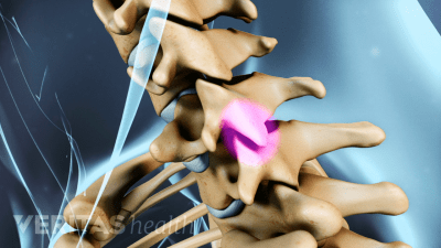 Lumbar Facet Joint Arthropathy | Spine-health
