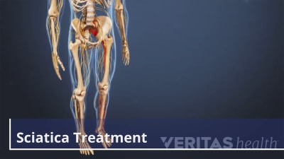 4 Steps to Relieve Sciatica Pain Video | Spine-health